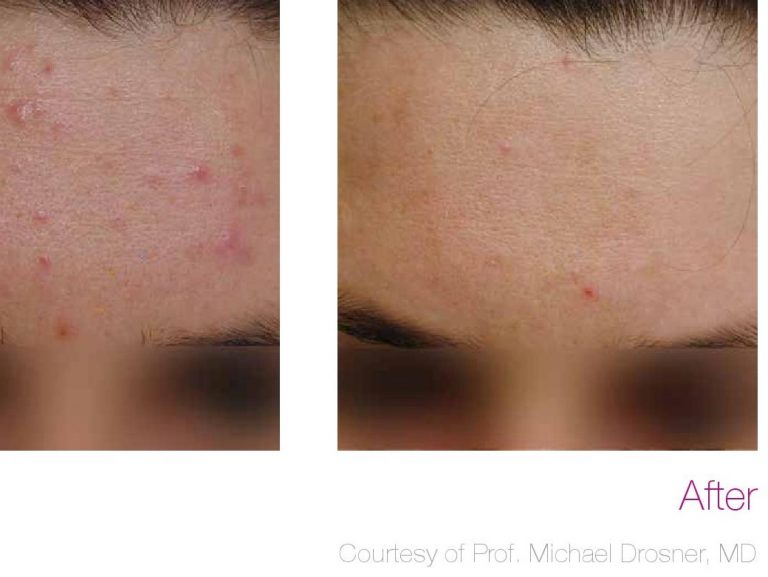 IPL provides effective acne relief - Lasermed laser clinic